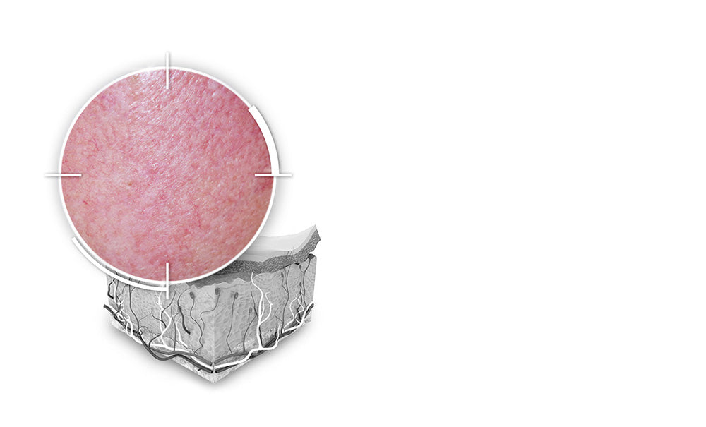 SKIN PRONE TO ROSACEA, BURNING AND TINGLING – Dermastir